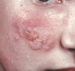 Autoimmune progesterone dermatitis